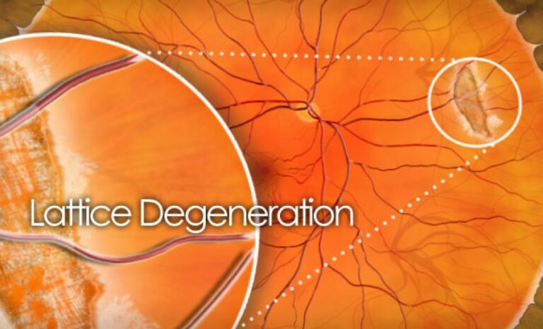 Lattice Degeneration | Dr. Bishop & Associates