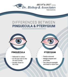 Pinguecula vs. Pterygium: What’s the Difference? | Dr. Bishop & Associates