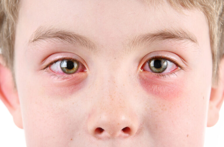 Pink Eye vs Stye: How To Tell The Difference | Dr. Bishop & Associates